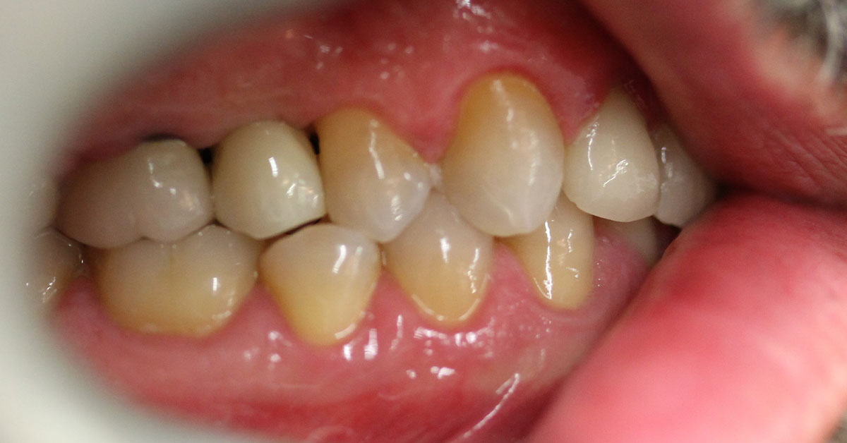 Dental Implants Islington | Award-Winning | DentalShine