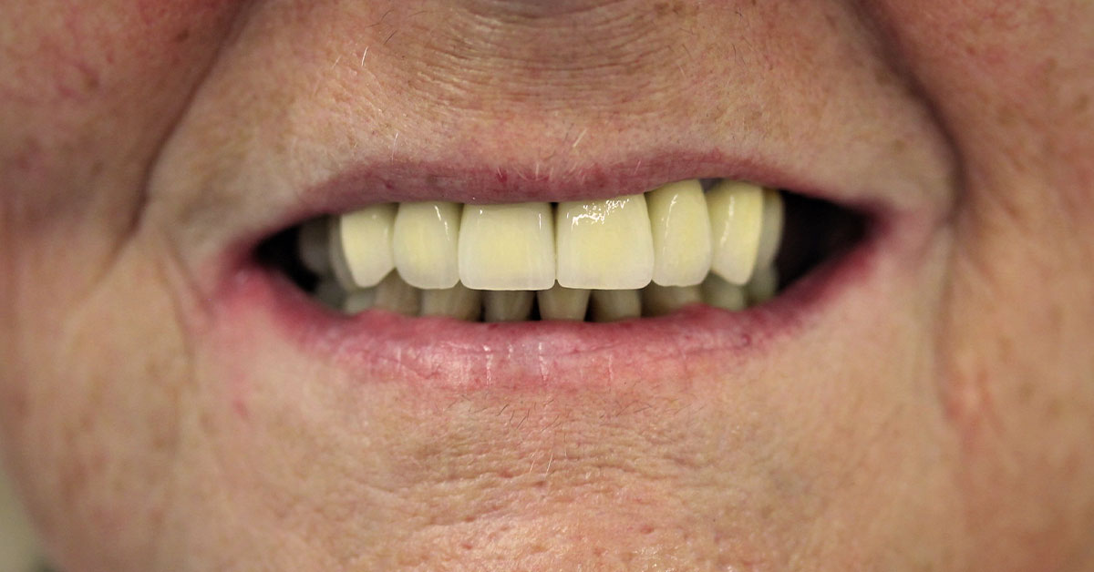 Smile Makeovers - DentalShine Islington