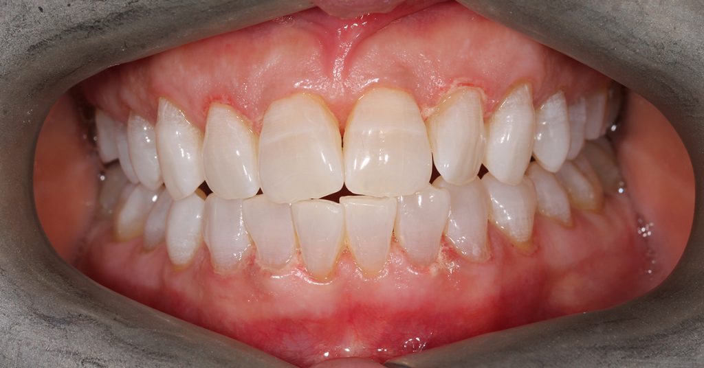 Brighter Smile with Teeth Whitening - DentalShine Islington