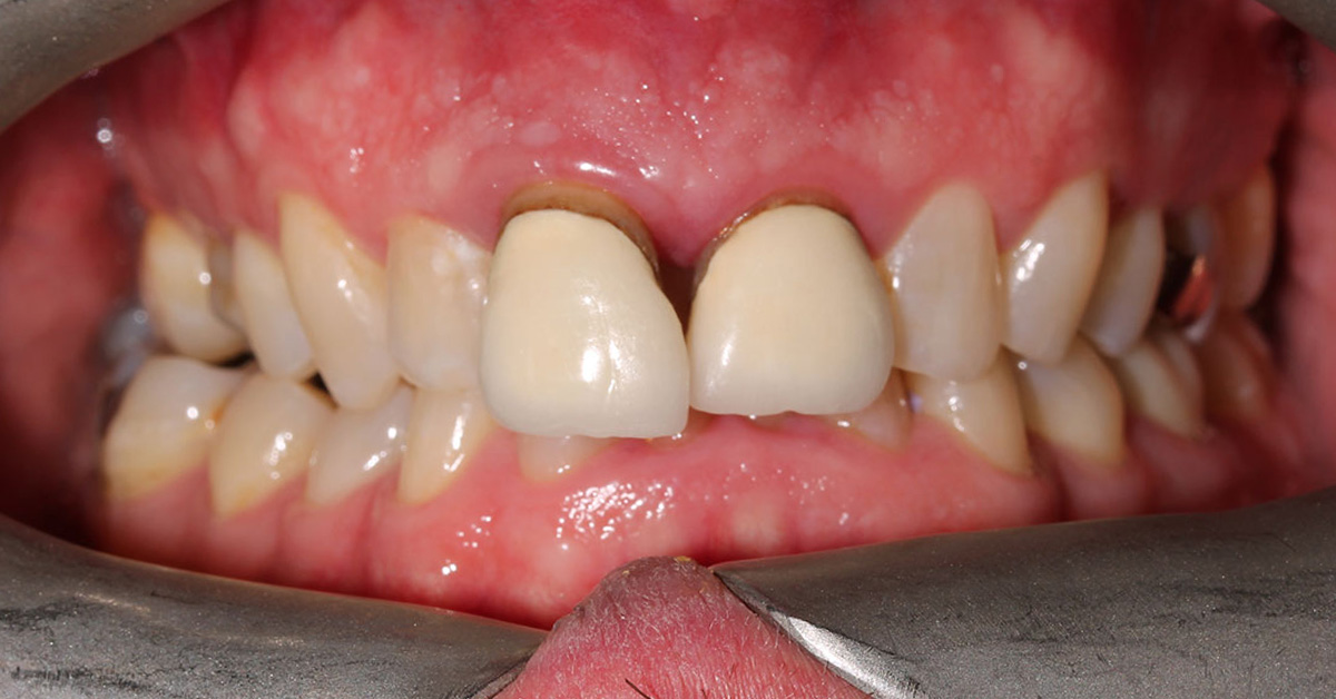 Smile Makeovers - DentalShine Islington